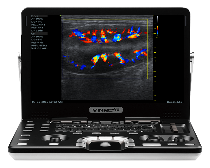 5 razones del porqué VINNO 5 es el ecógrafo portátil que necesitas